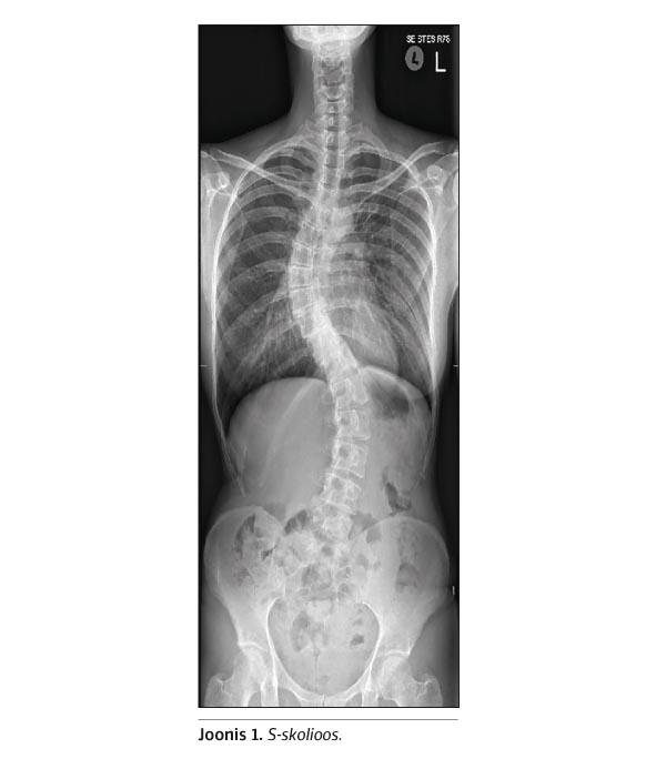 Skolioosi ravist perearstile | Med24