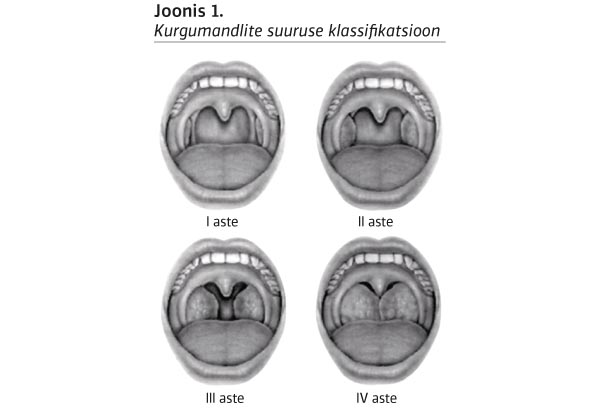 Krooniline tonsilliit – kas ja millal opereerida? | Med24